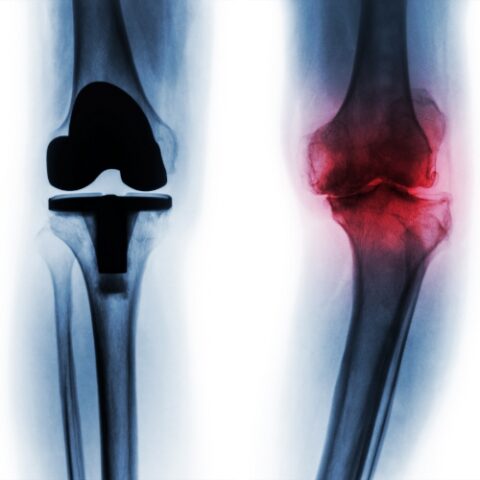 Total Knee Replacement - Shanti
