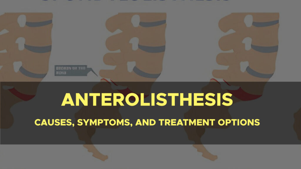Understanding Anterolisthesis: Causes, Symptoms, and Treatment Options ...